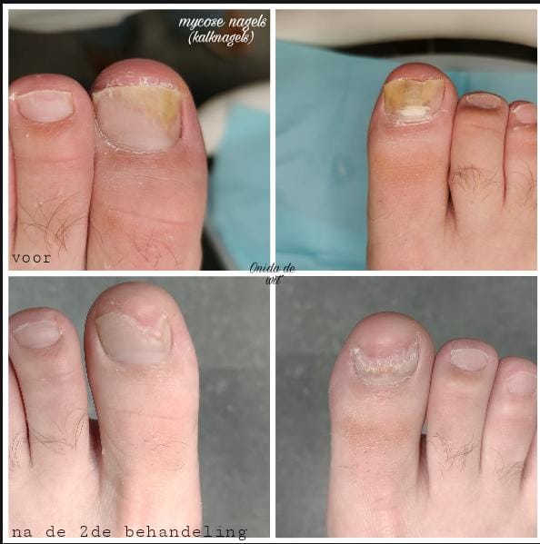 Behandelingen | Medisch Pedicure Landgraaf